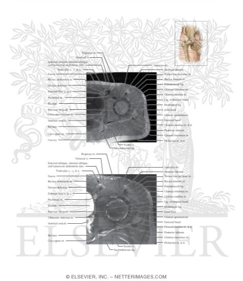 Cross Section of the Hip: Axial View