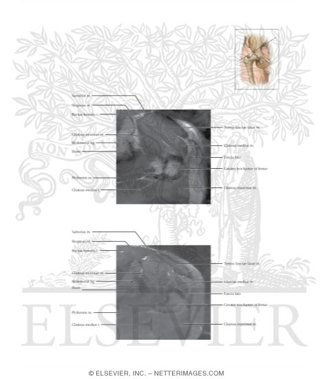 Cross Section of the Hip: Axial Oblique View