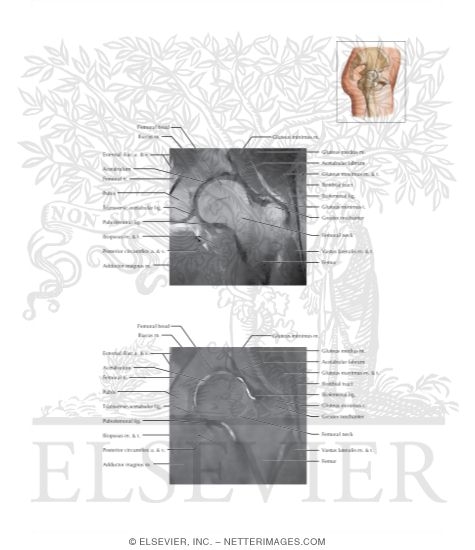 Cross Section of the Hip: Coronal Oblique View