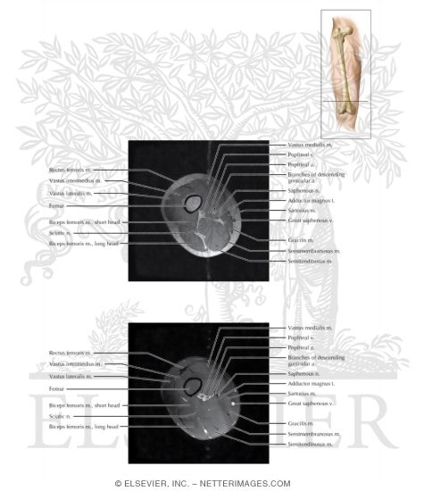 Cross Section of the Thigh: Axial View