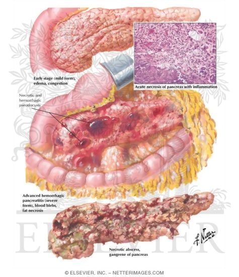Gross Morphology Of Acute Pancreatitis