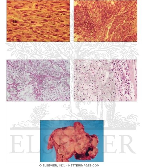 Malignant Soft Tissue Tumors