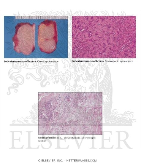 Benign Soft Tissue Tumors