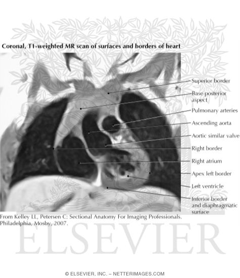 Coronal, T1 Weighted MR Scan of Surfaces and Borders of Heart