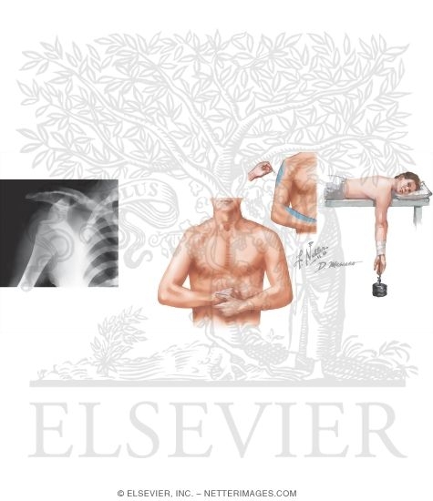 Watermarked preview of unlabeled image: Anterior Dislocation of ...