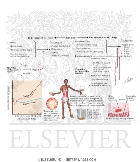 Metabolic and Systemic Effects of Burns