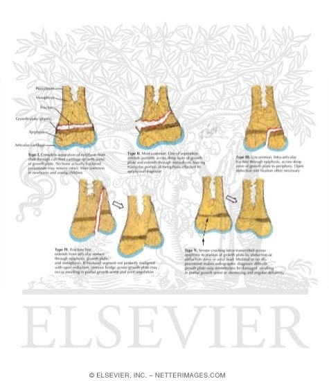 Injury to Growth Plate (Salter-Harris Classification)