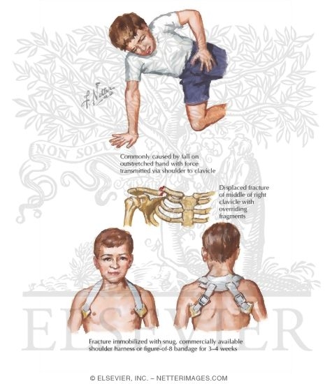 Fracture of Clavicle In Children
