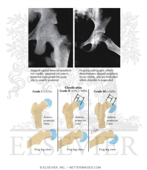 Slipped Capital Femoral Epiphysis