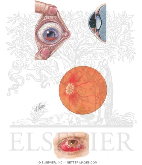 Ocular Trauma