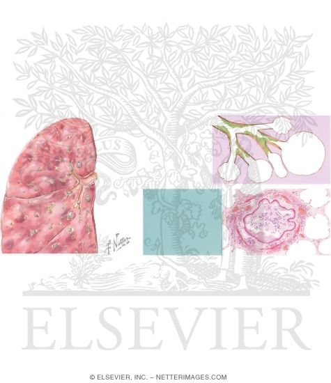 Pathogenesis of Bronchiolitis