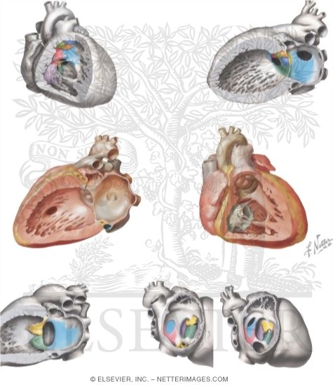 Ventricular Septal Defect