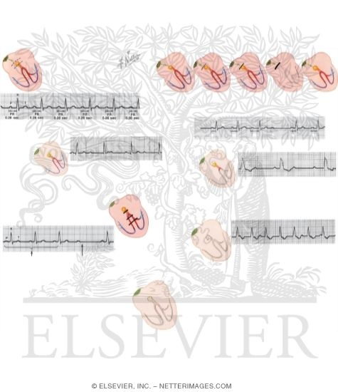 Atrioventricular Conduction Variations