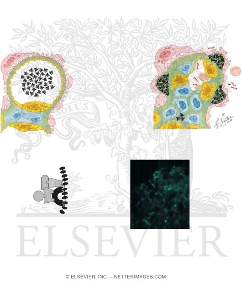 Hypothesis of Pathogenesis of Acute Glomerular Injury By Circulating ...