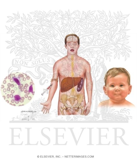 Clinical Presentation of Epstein-Barr Virus