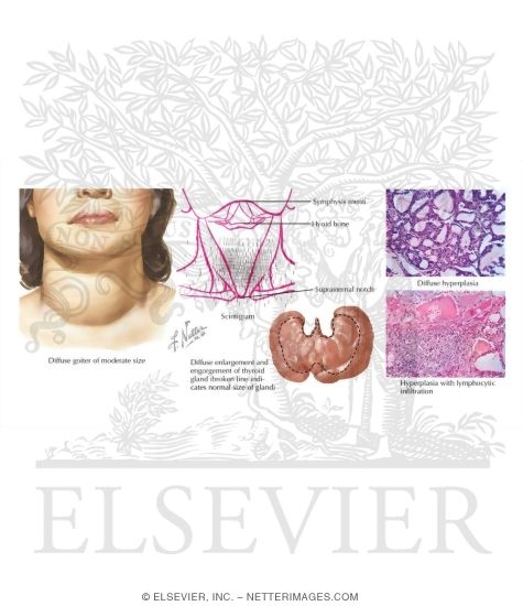 Thyroid Pathology in Diffuse Hyperthyroidism (Graves' Disease)