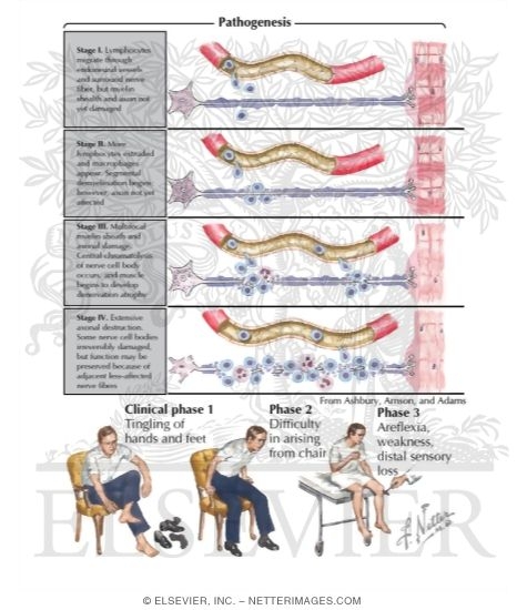 AIDP (Guillain-Barre Syndrome)