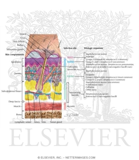 Cross-Section of the Skin Showing Layer and Types of Infections