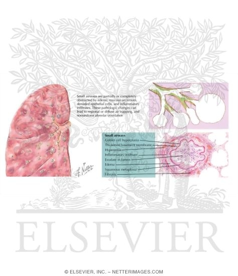 Pathogenesis of Bronchiolitis