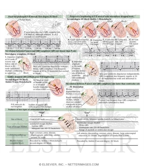 Atrioventricular Conduction Variations