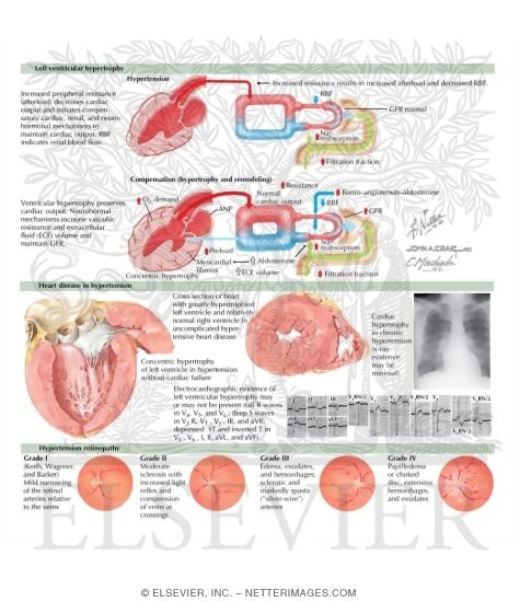 Clinical Presentation of Hypertension Clinical Presentation of Hypertension