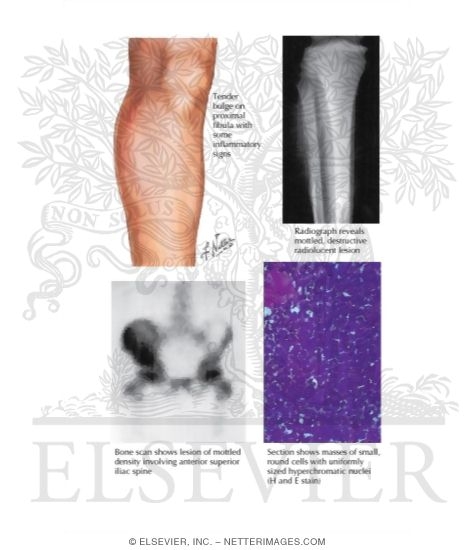 Ewing's Sarcoma
