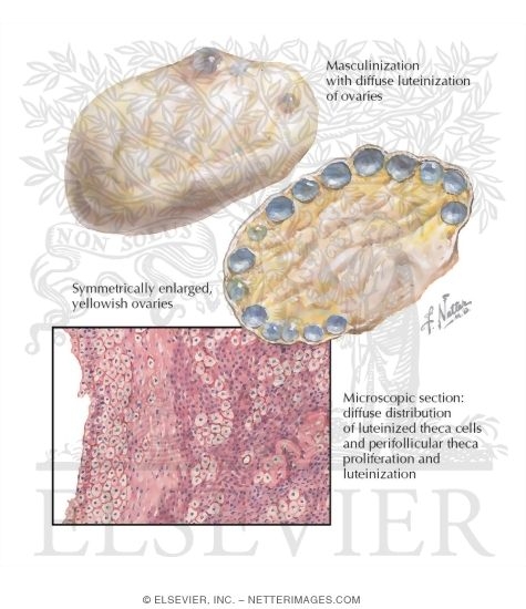Polycystic Ovarian Disease