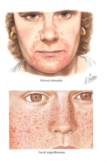 Perioral Dermatitis and Facial Angiofibromas