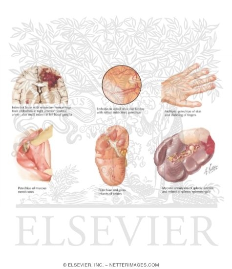 Bacterial Endocarditis - Remote Embolic Effects