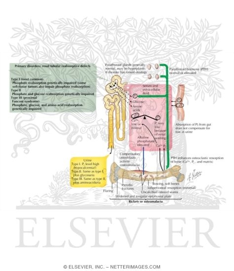 Hypophosphatemic Rickets