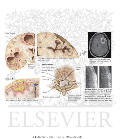 Parameningeal Infections