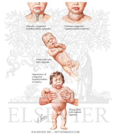 carotenoderma hypothyroidism