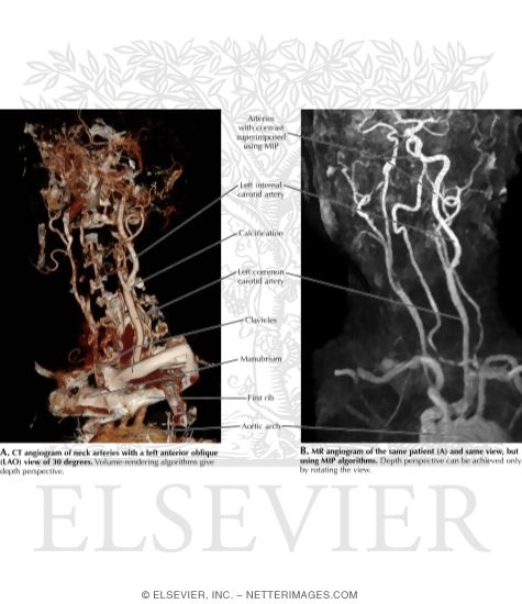 Angiography: Computed Tomography Angiogram Vs. Magnetic Resonance ...