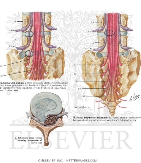 Lumbar Disc Herniation