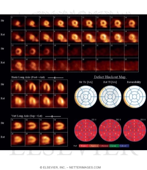 Single-Photon Emission Computed Tomography (SPECT)