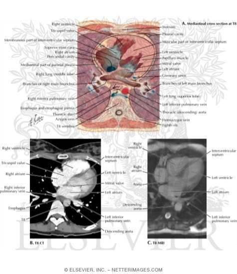T8 Mediastinum Cross Section With T8 CT and MRI