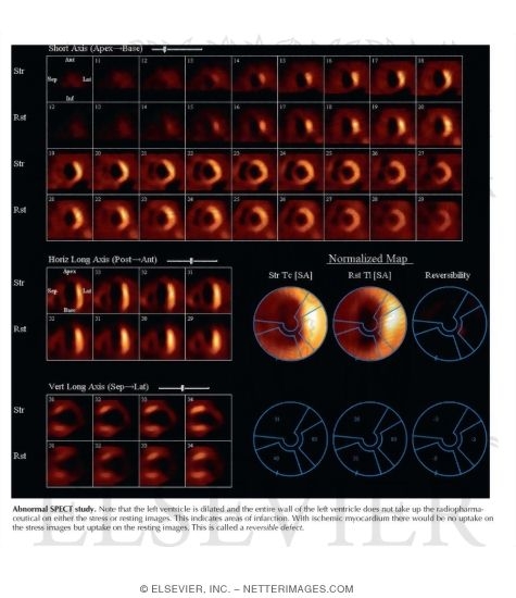 Single-Photon Emission Computed Tomography (SPECT)