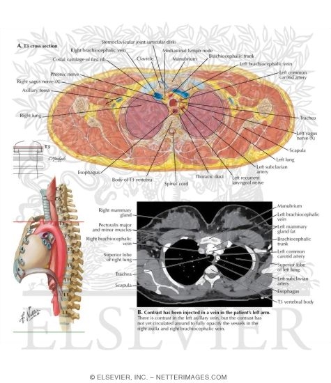 T3 Cross Section and T3 CT
