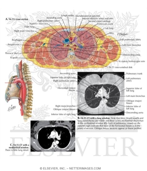 T4-T5 Cross Section With Two T4-T5 CTs
