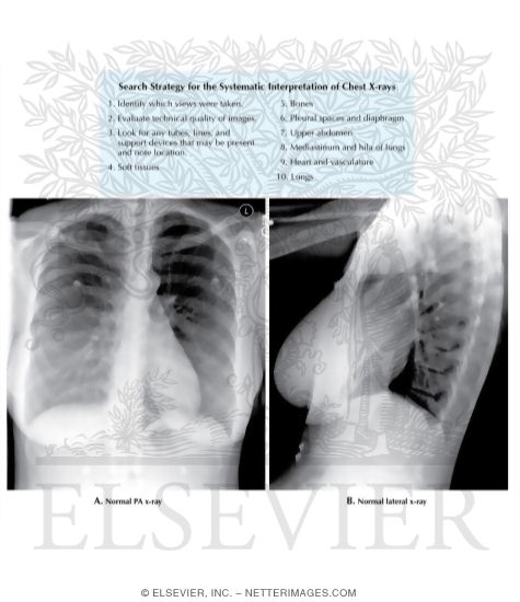 normal chest xray labeled