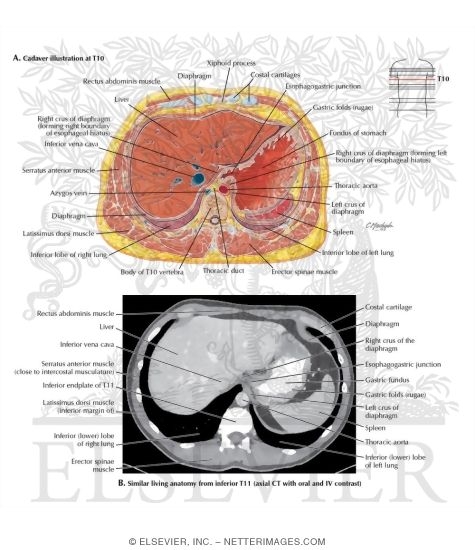 Cross Section at T10 With CT