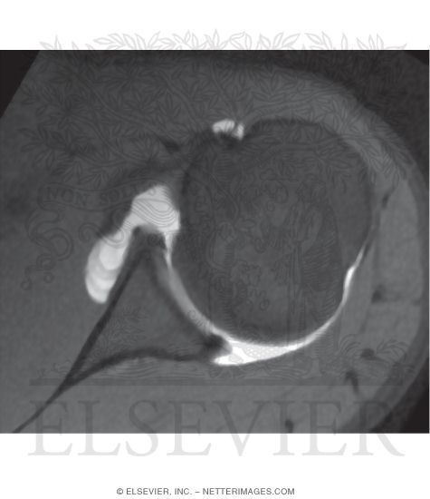 Shoulder Joint Imaging Studies (Axial T1 Arthrogram)