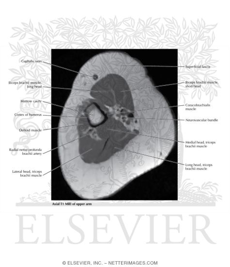 Upper Arm MRI
