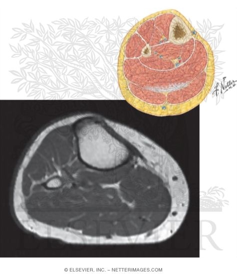 Axial T1 MRI Through the Leg