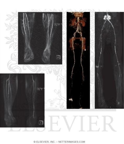 Vascular Studies of the Lower Extremity: CTA/MRA of the Leg and Lower ...