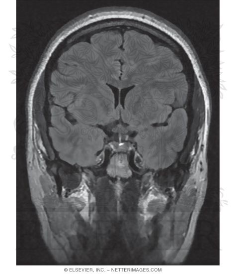 T2 FLAIR Coronal MRI Through the Optic Chiasm