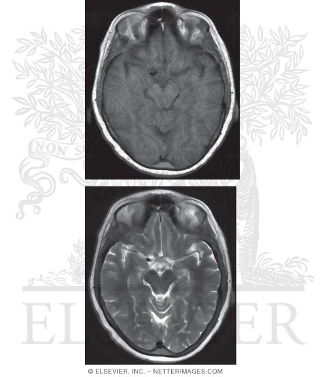 T1 and T2 Axial MRI Through the Optic Chiasm