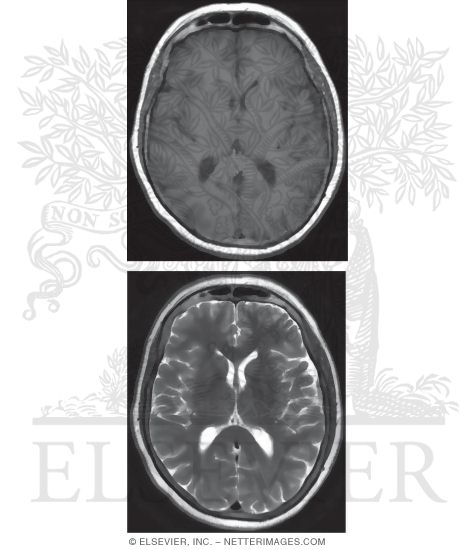 Ventricles Of The Brain Mri