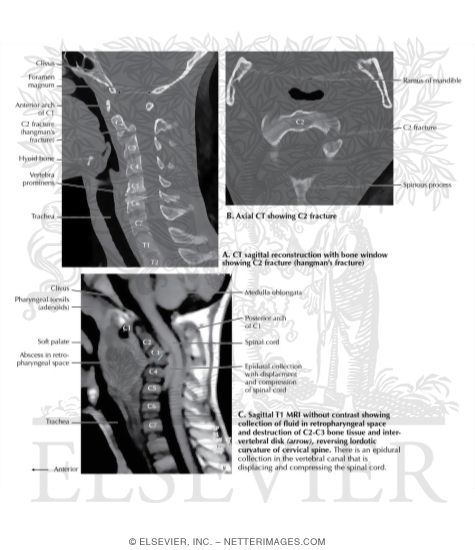 Imaging of Cervical Trauma and Pathology