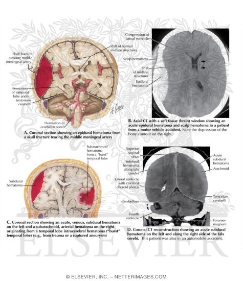 Imaging of Epidural and Subdural Bleeding
